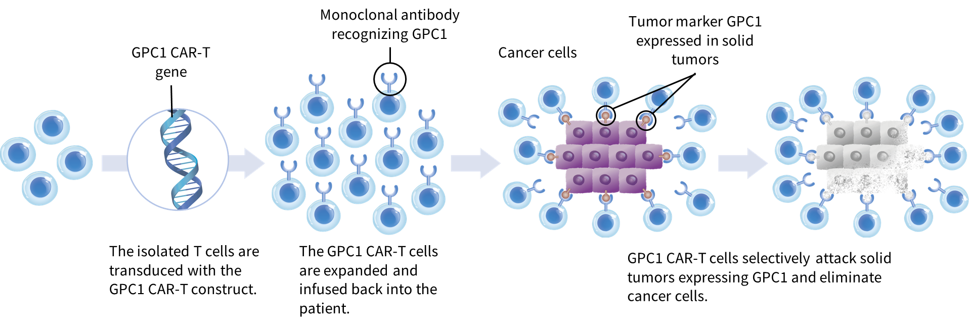 Clinical Pipeline - GPC1 CAR-T therapy