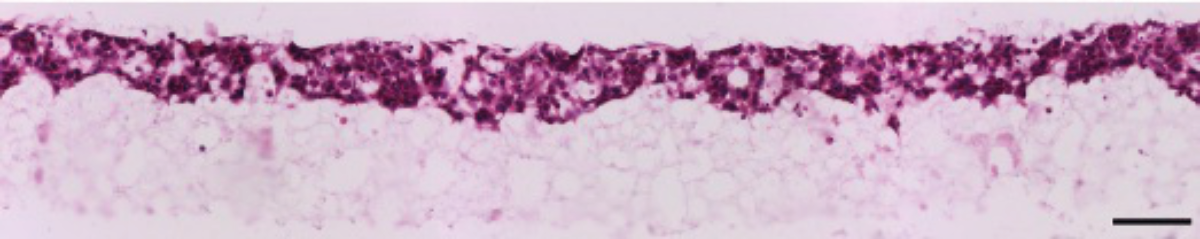 Alvetex Scaffold Protocol: Breast Invasive Ductal Carcinoma BT-474 Cell ...