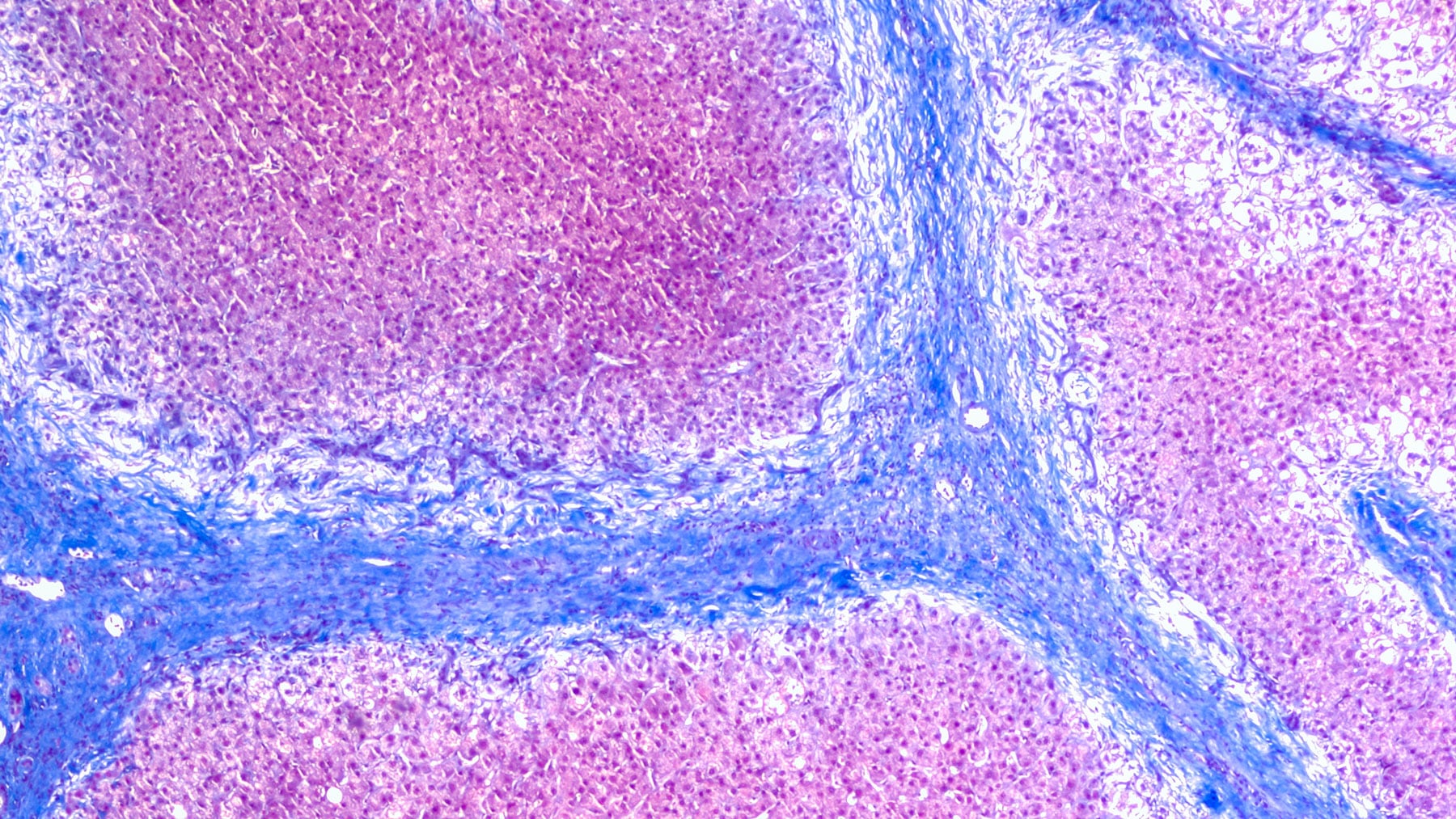 Modeling Fibrosis Progression Ex Vivo: Opportunities for Anti-Fibrotic ...